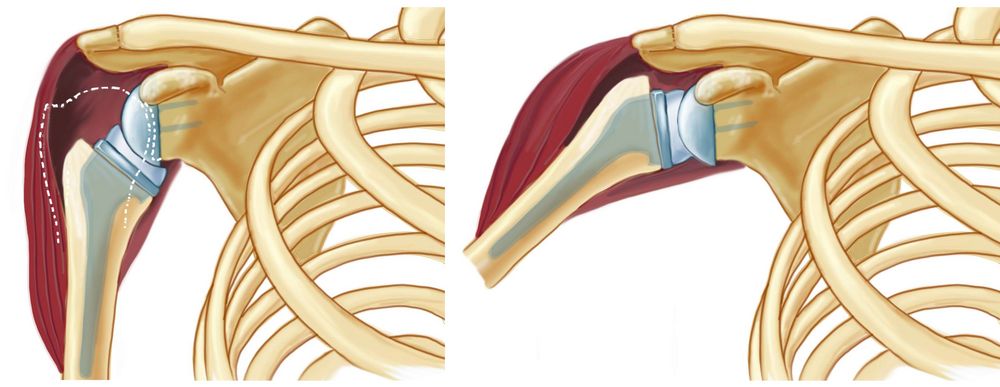 Operative Versorgung proximale Humerusfraktur