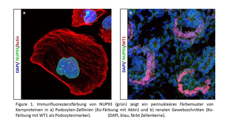 Punktmutationen in Proteinen der Kernpore, wie beispielsweise des ...