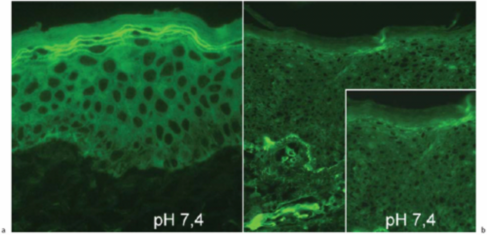 Netzwerk Ichthyose: Autosomal recessive congenital ichthyosis (ARCI)