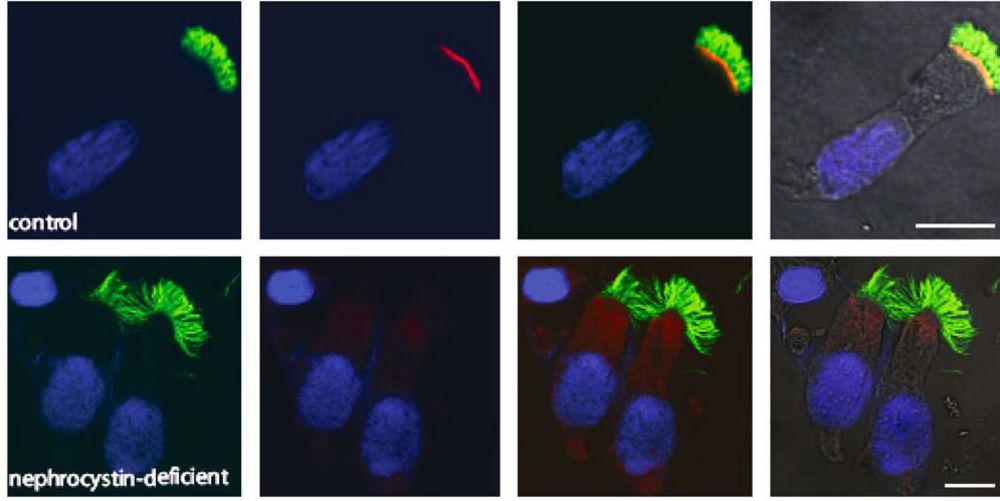 Study: Nephronophthisis