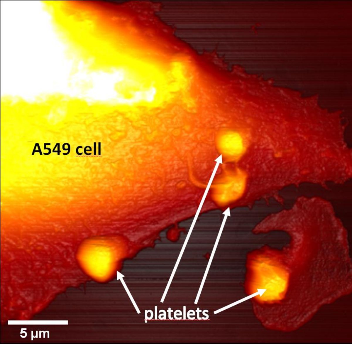 Platelets in Cancer
