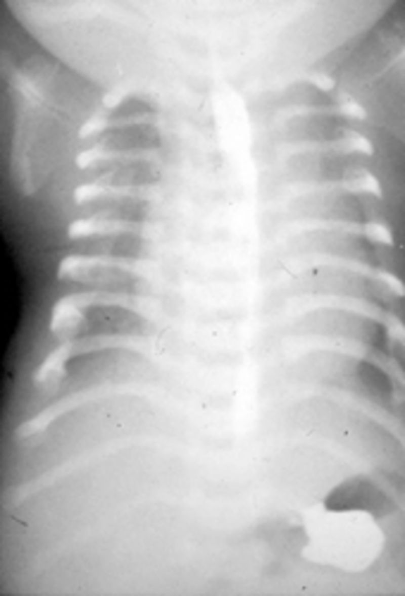 Jeune-Syndrom